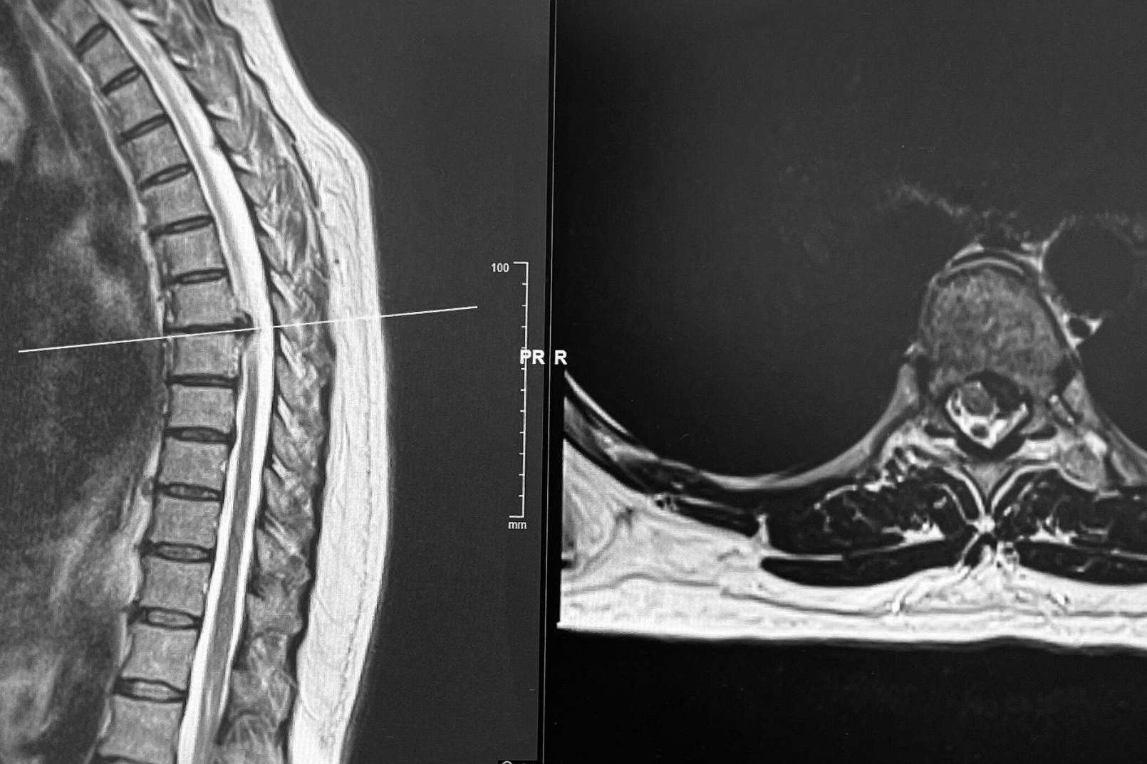 Cirugía de hernia discal con el neurocirujano especialista Dr. Carlos ...